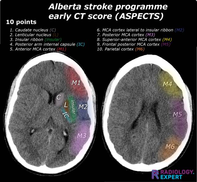 Interventional Radiology - The Stroke Patient